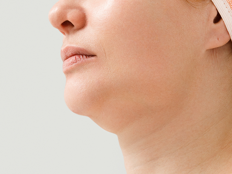 Redefine tu Contorno con Laskin: Tratamientos para la Papada