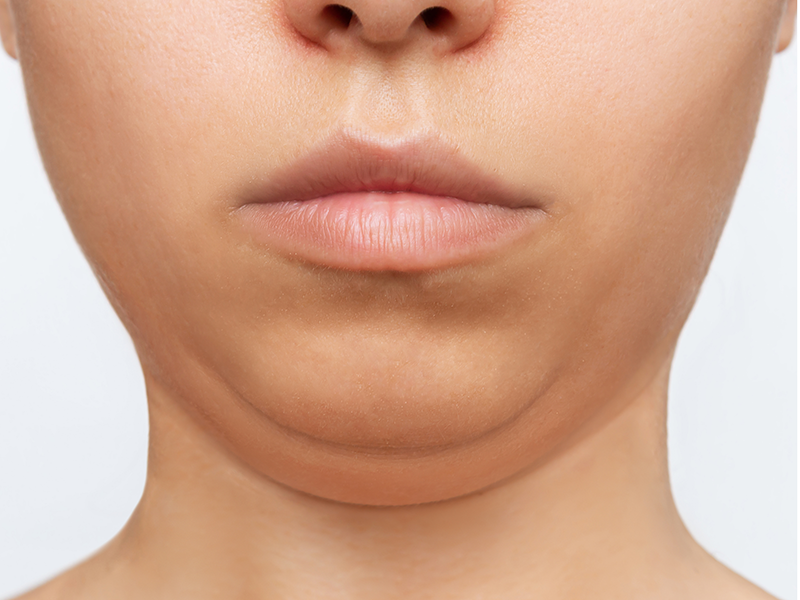 Redefine tu Contorno con Laskin: Tratamientos para la Papada